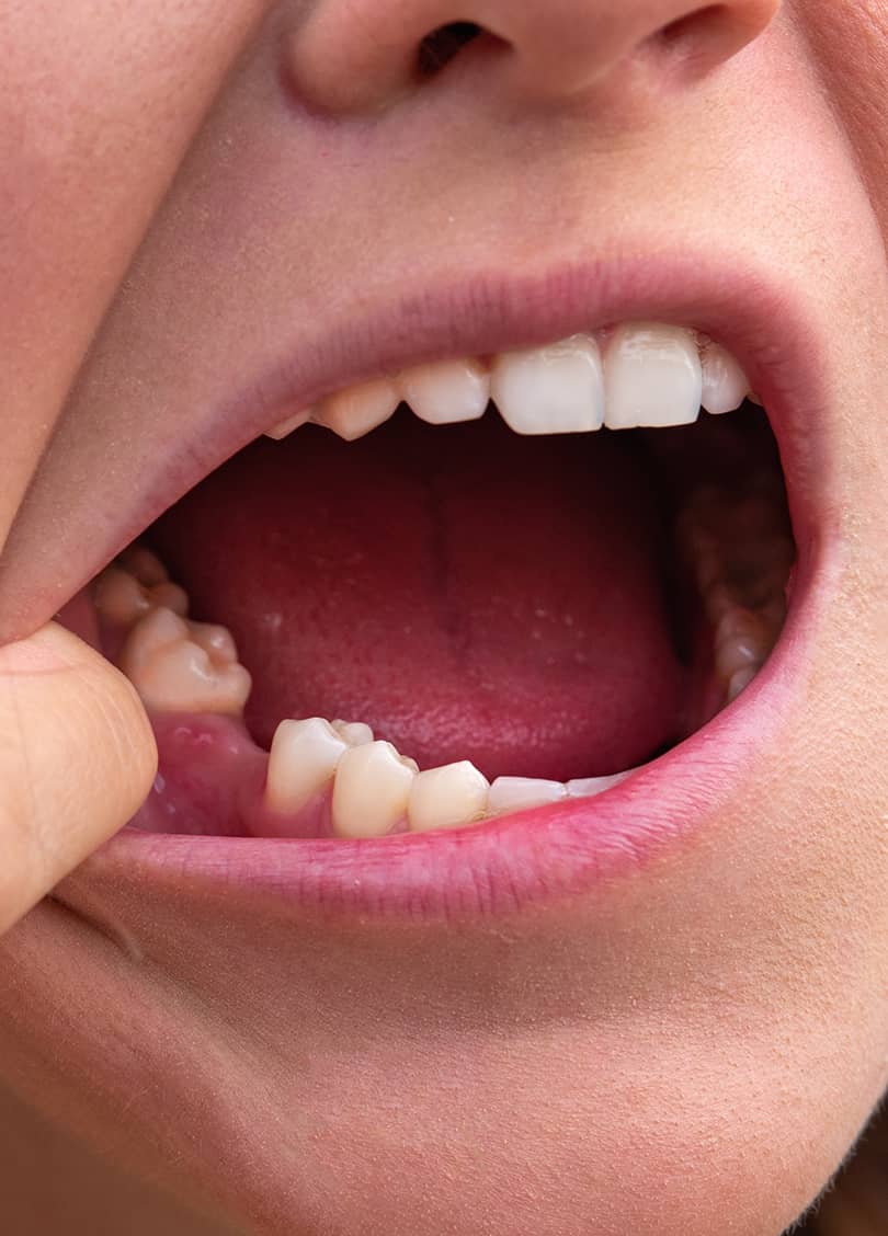 Missing Teeth - Smile 360 Dental | Dentists in Harrow, Greater London